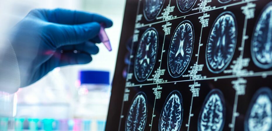 Nueva técnica permite ver oligómeros de parkinson